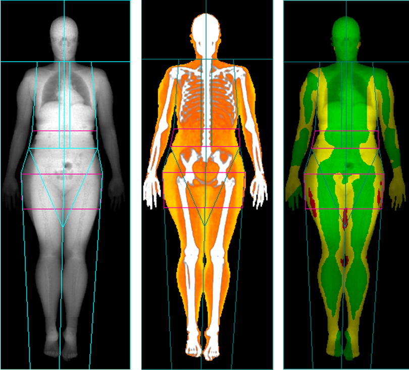 GE Healthcare Body Composition Report Sample GE Healthcare Body Composition Report Sample